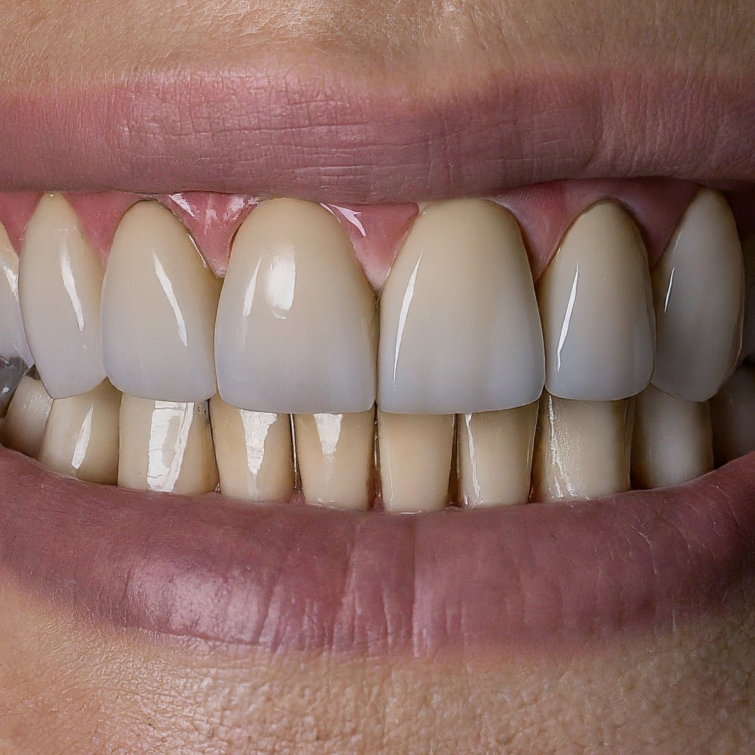 Emax Crowns: Achieve Your Most Beautiful Smile in 2 Visits